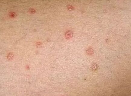 Psoríase no rosto: sinais, terapia com remédios populares e ...